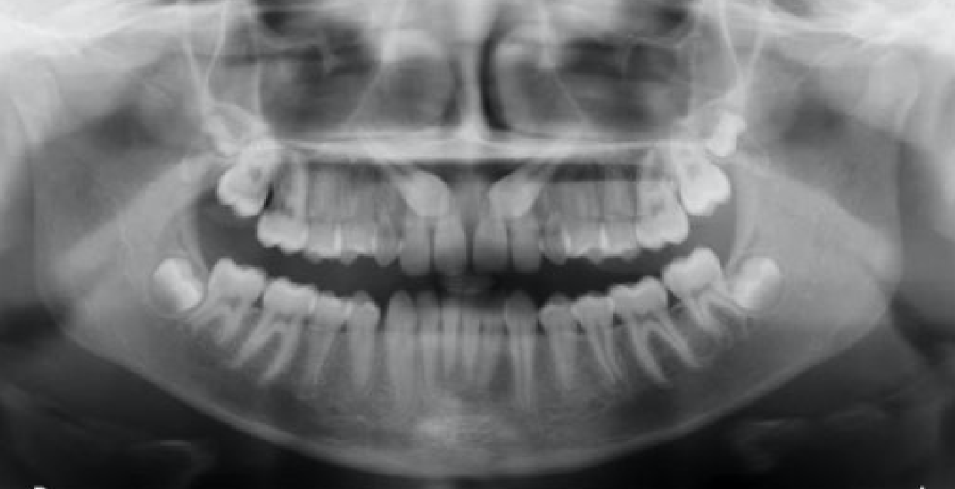 Chirurgie des dents incluses - Cabinet Maxillo-Facial privé de Saint ...