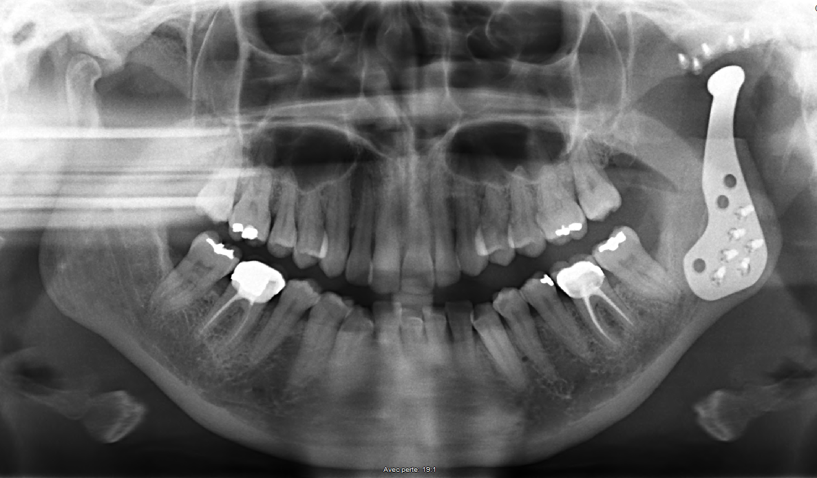 Pathologies de l'articulation temporo-mandibulaire - Cabinet de ...